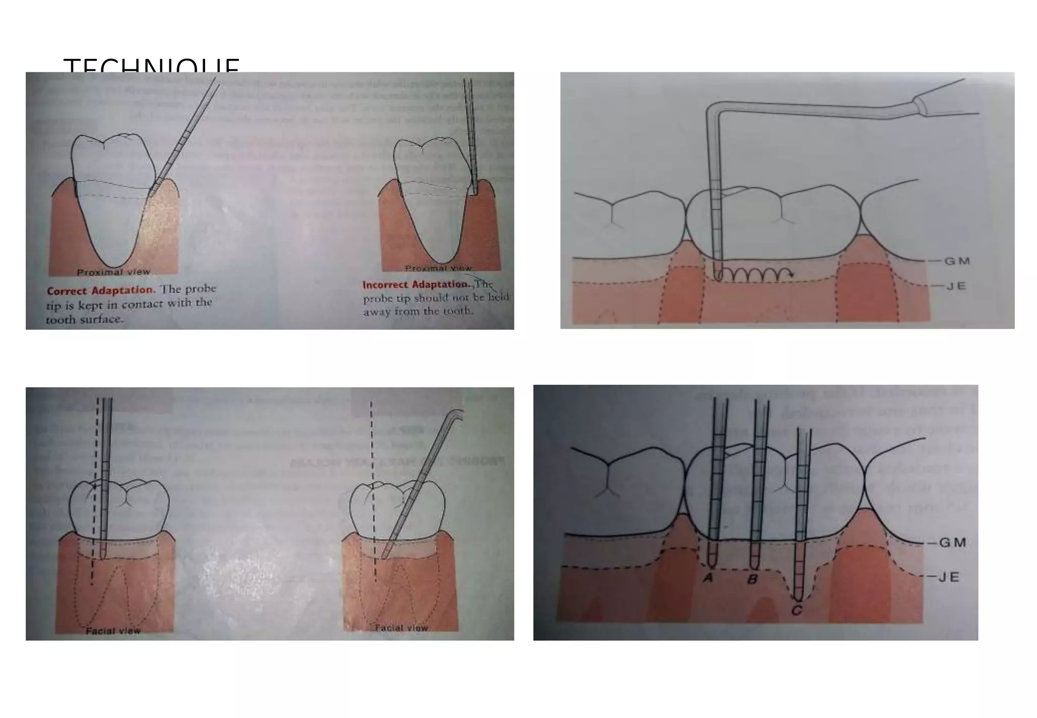 Periodontal probes | PPTX