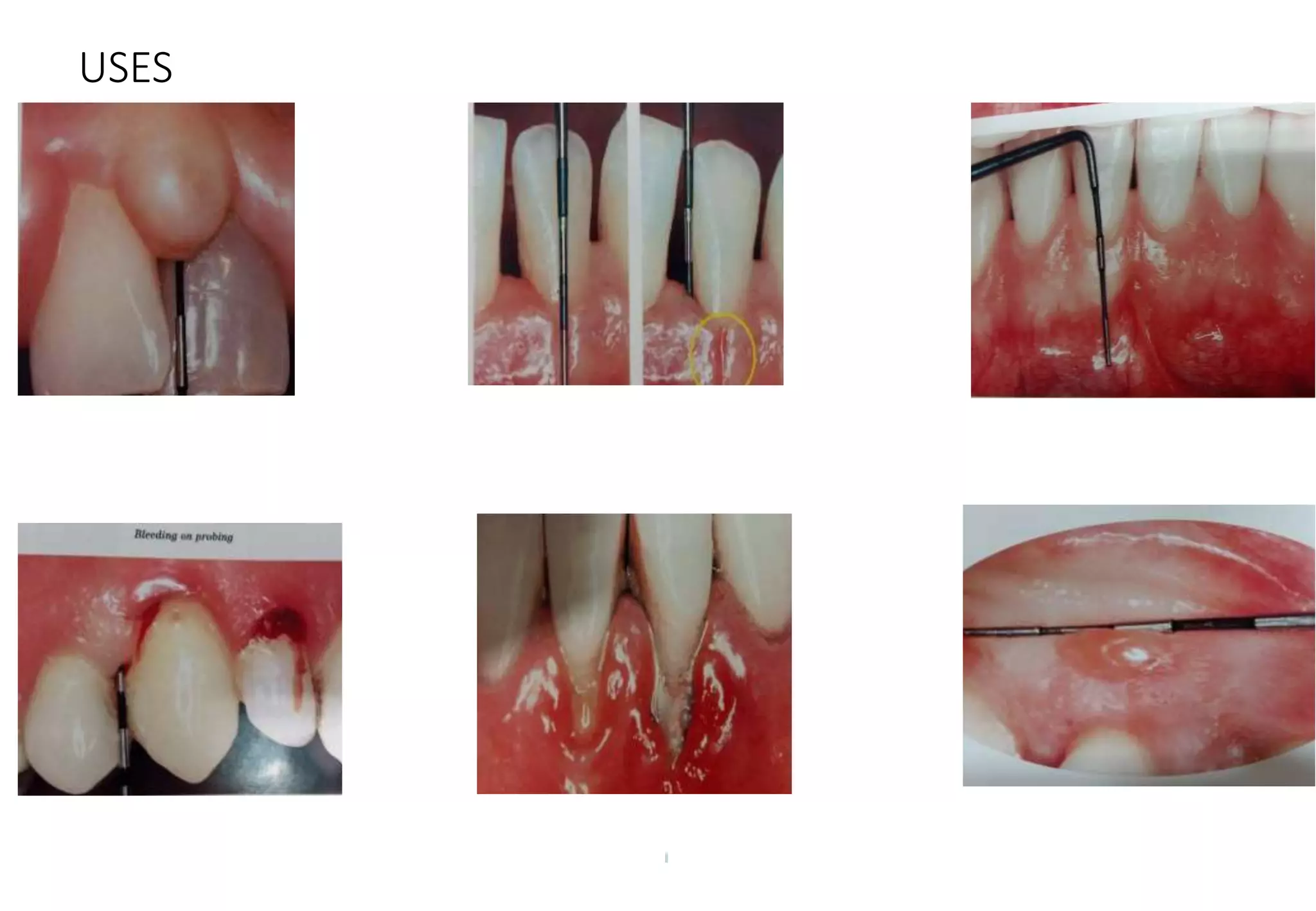 Periodontal probes | PPTX