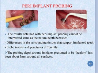 Periodontal Probes | PDF