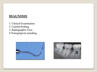 Periodontal probing | PPTX | Dental Health | Diseases and Conditions