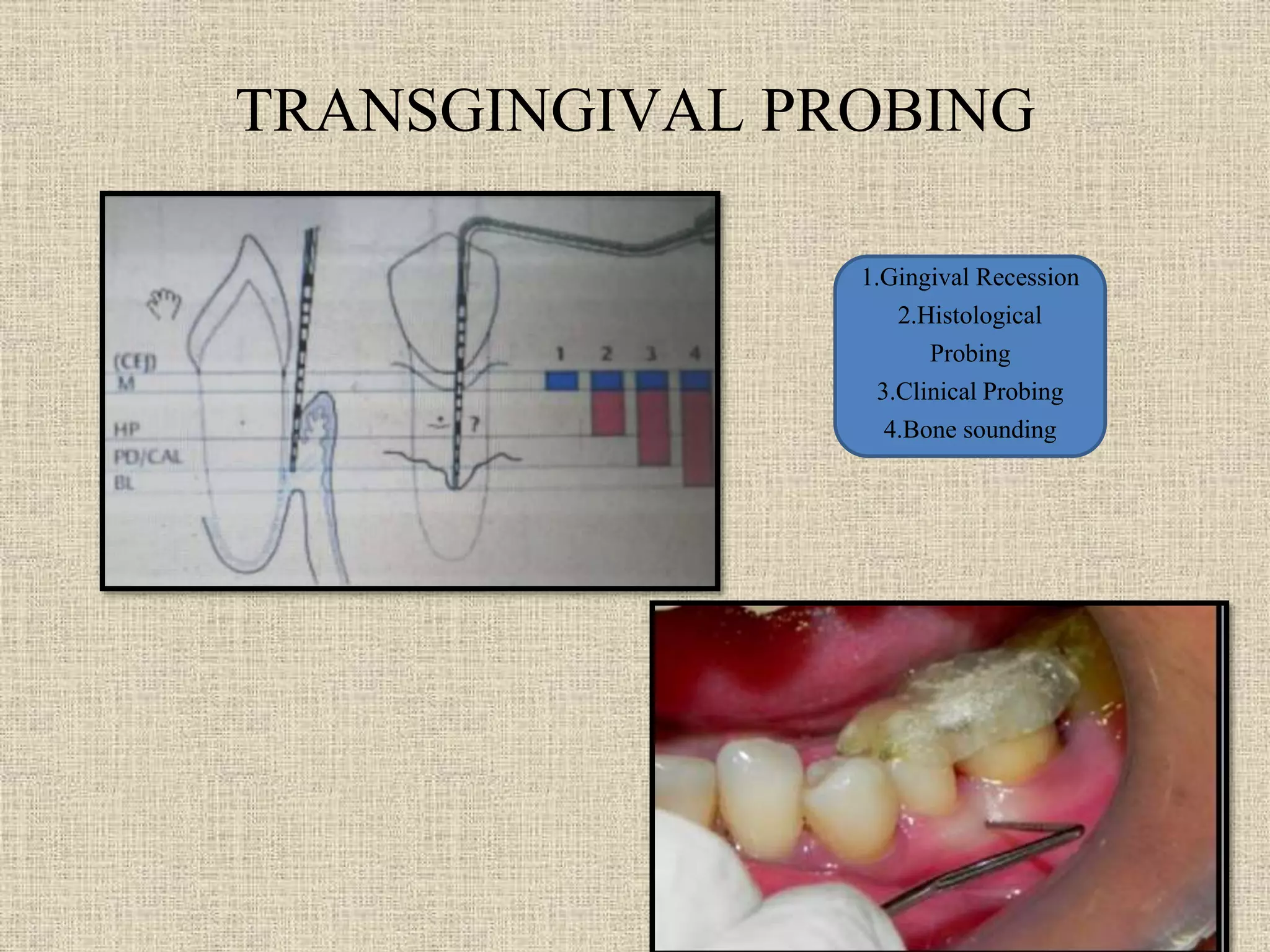 Periodontal probing and techniques | PPTX