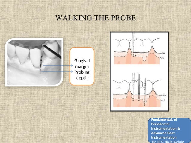 Periodontal probing and techniques | PPTX