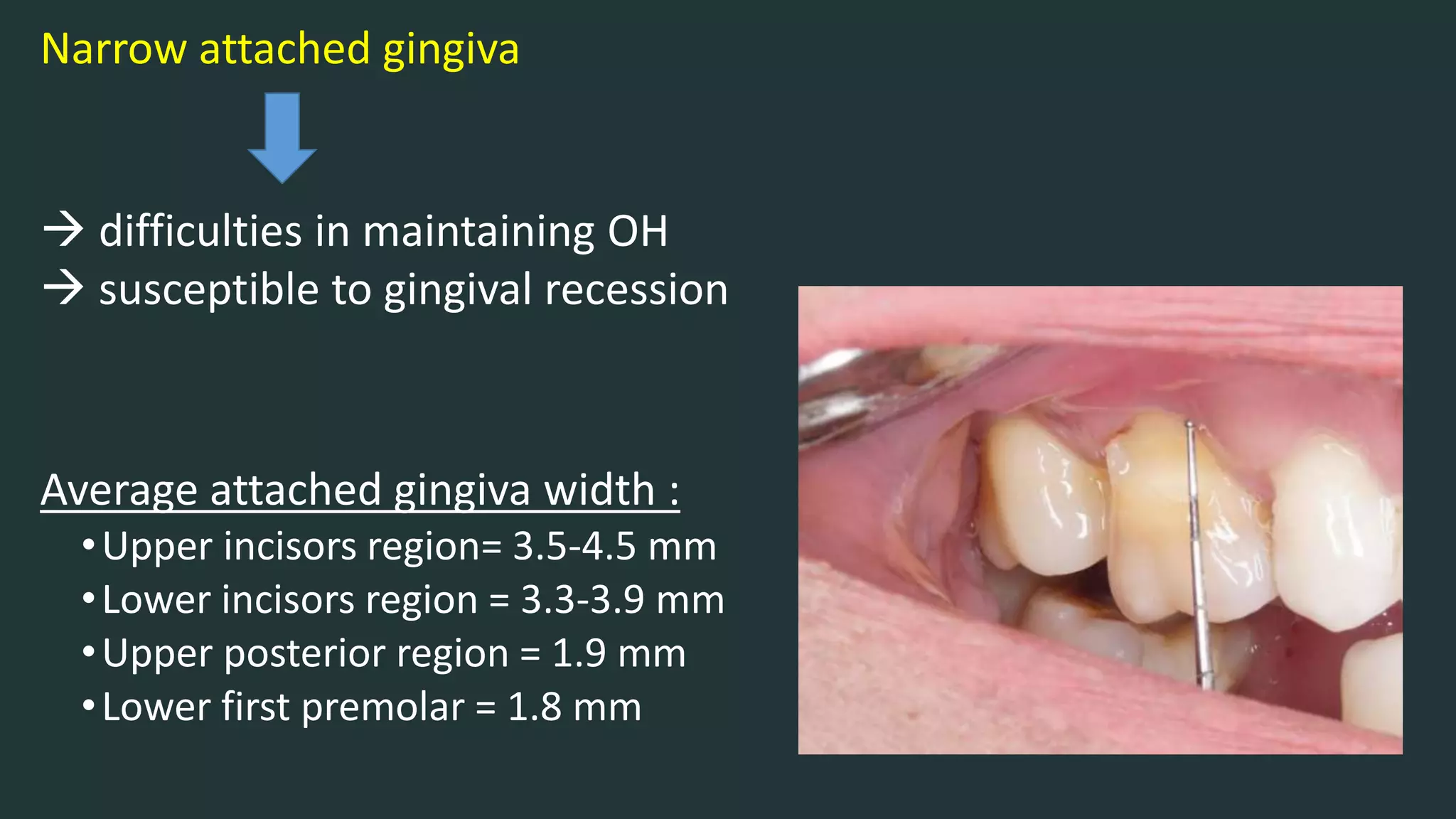 periodontal problem at the specific area.pptx | Dental Health ...
