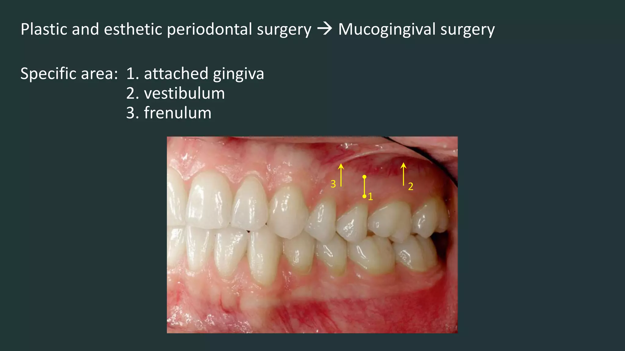 periodontal problem at the specific area.pptx