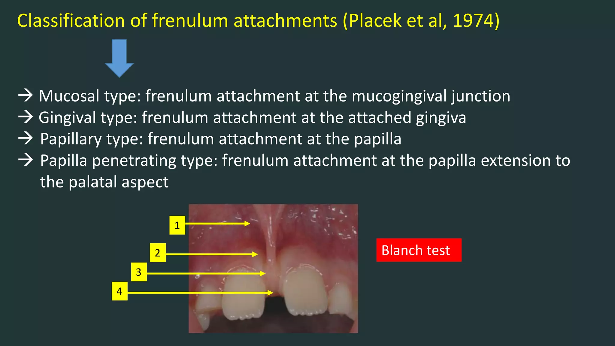 periodontal problem at the specific area.pptx
