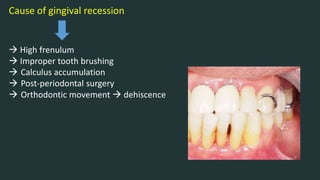 periodontal problem at the specific area.pptx