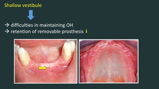 periodontal problem at the specific area.pptx