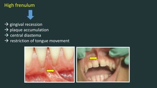 periodontal problem at the specific area.pptx