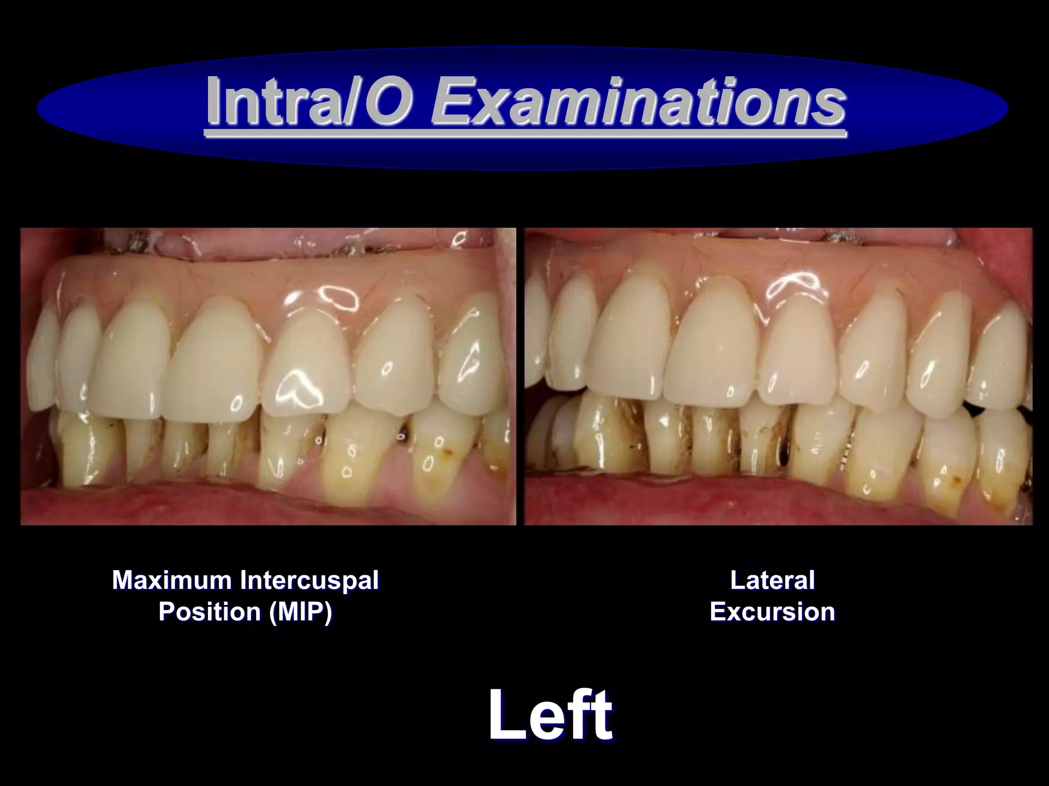 Periodontal prognosis and prosthetic treatment planing | PPTX