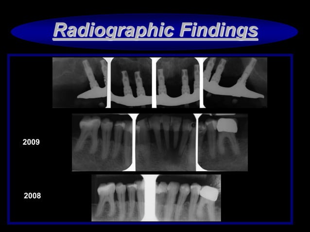Periodontal prognosis and prosthetic treatment planing | PPTX | Dental ...