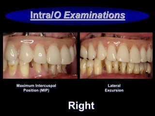 Periodontal prognosis and prosthetic treatment planing | PPTX | Dental ...