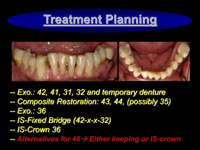 Periodontal prognosis and prosthetic treatment planing | PPTX | Dental ...