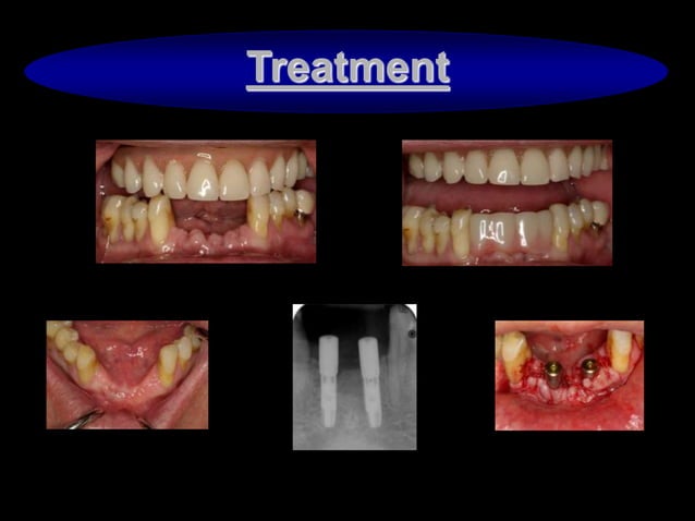 Periodontal prognosis and prosthetic treatment planing | PPTX | Dental ...