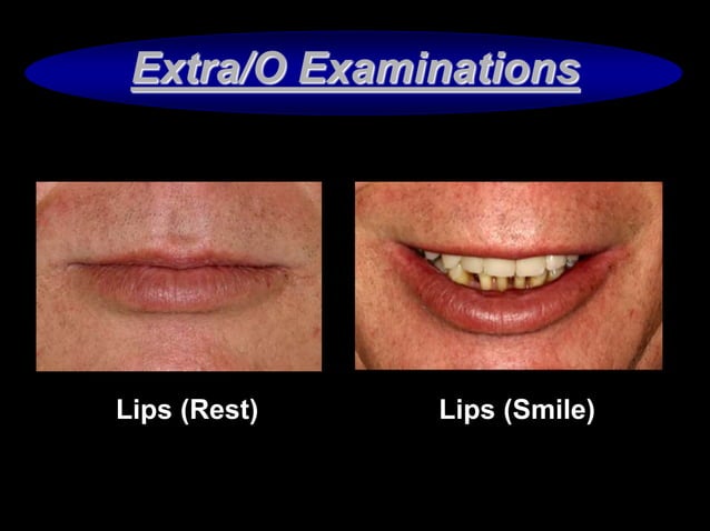 Periodontal prognosis and prosthetic treatment planing | PPTX | Dental ...