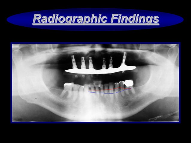 Periodontal prognosis and prosthetic treatment planing | PPT