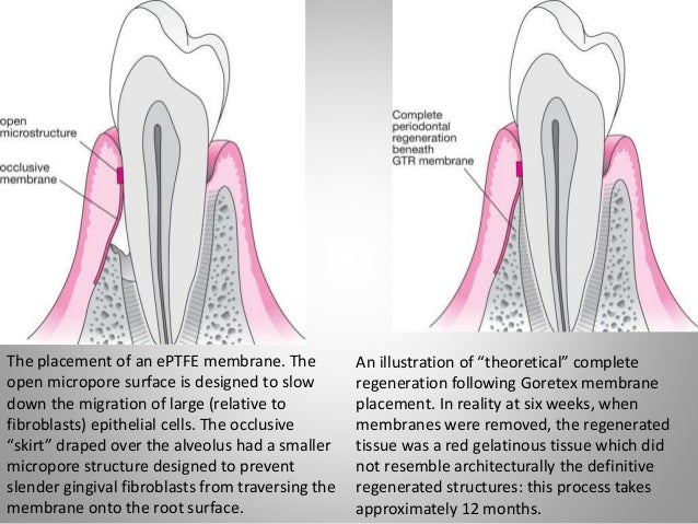 Periodontal regeneration