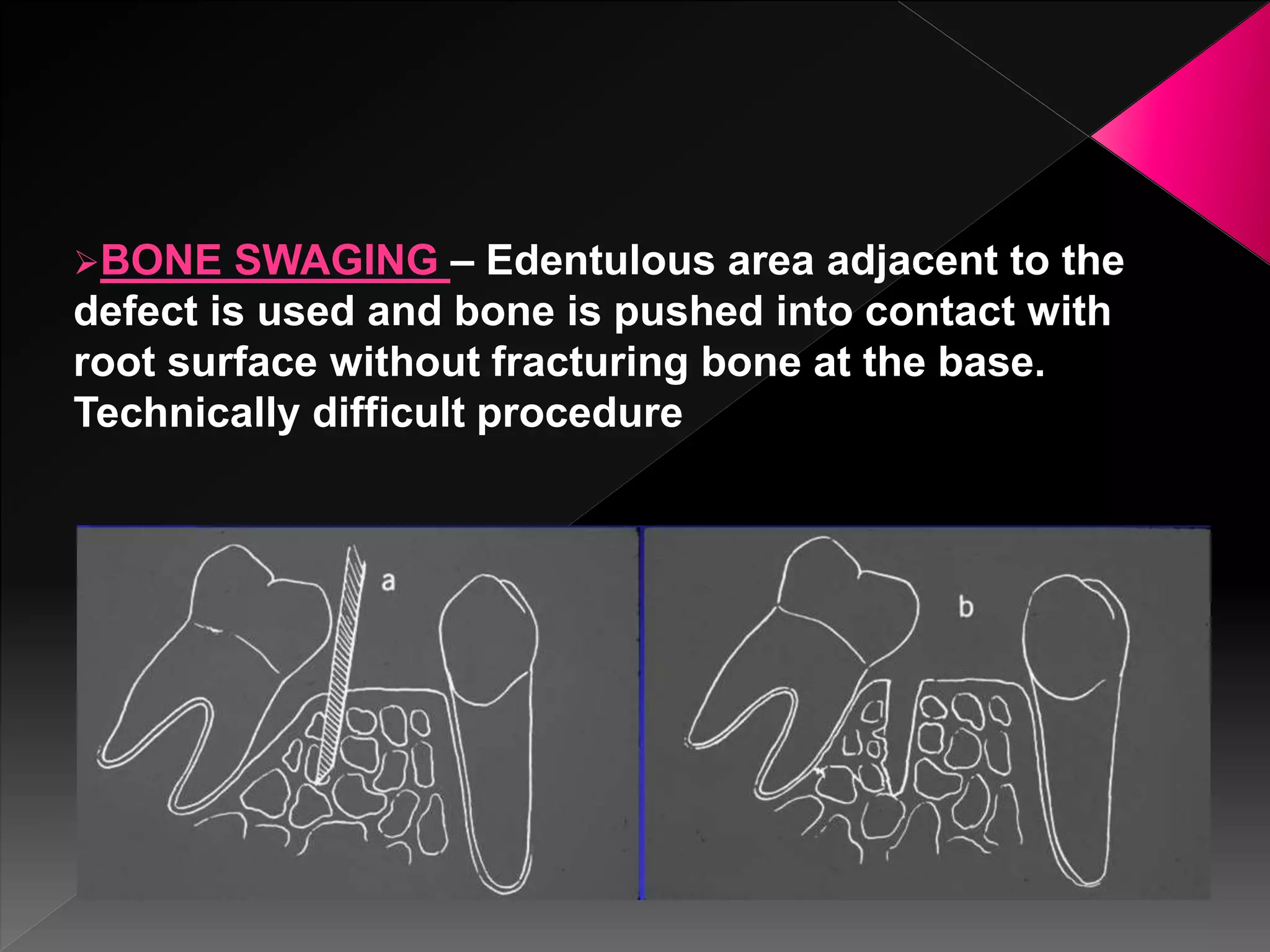 Periodontal regeneration | PPTX