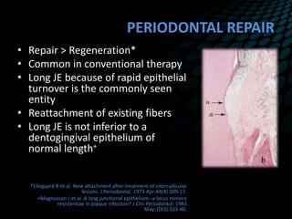Periodontal regeneration current concepts | PPTX