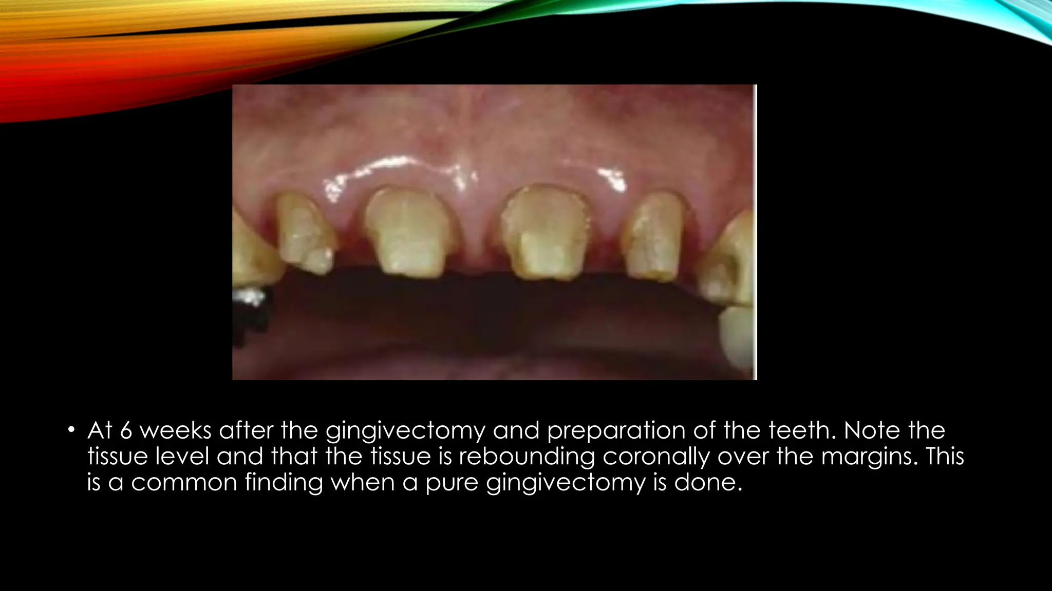periodontal restorative inter relationship.pptx