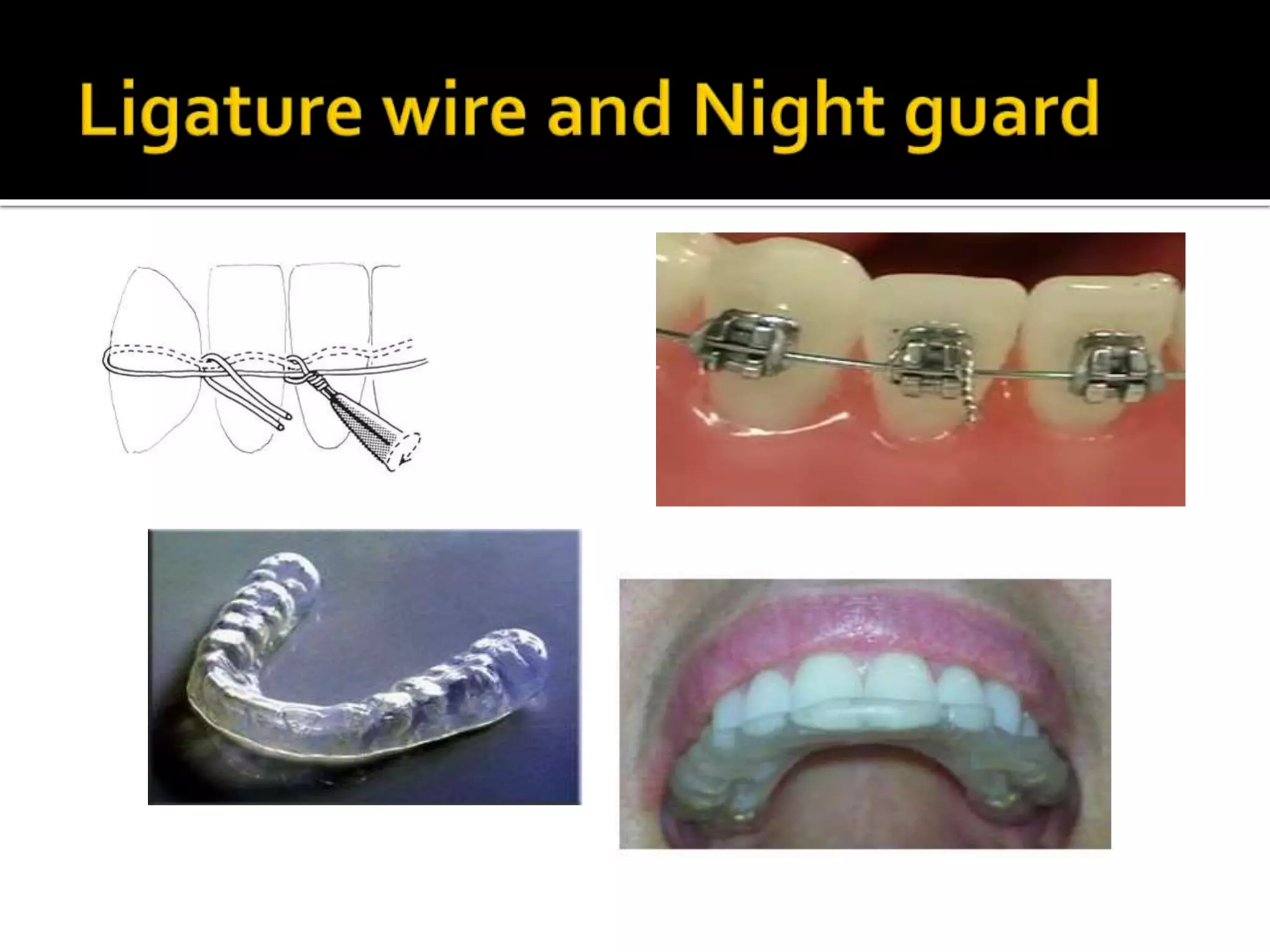 Periodontal splinting | PPTX