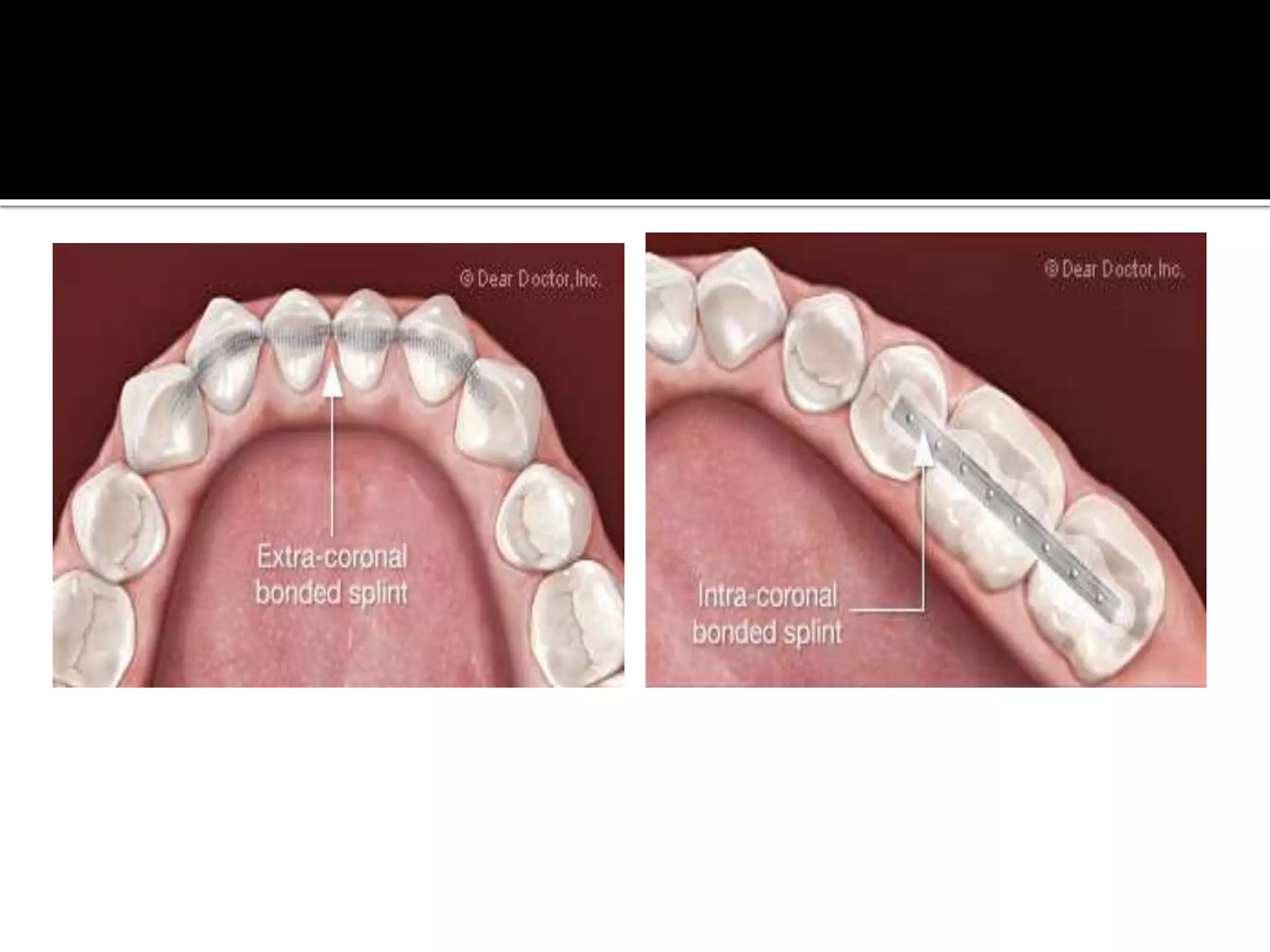 Periodontal splinting | PPTX