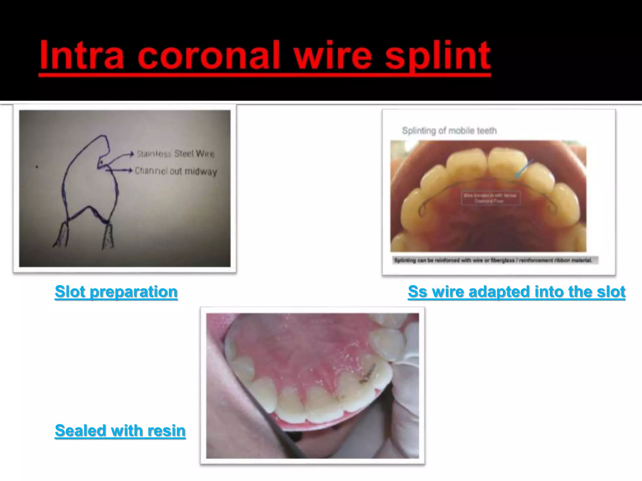Periodontal splinting | PPTX