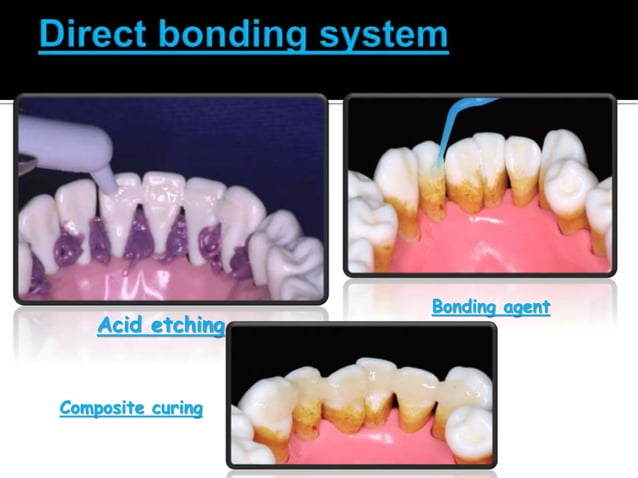 Periodontal splinting | PPTX