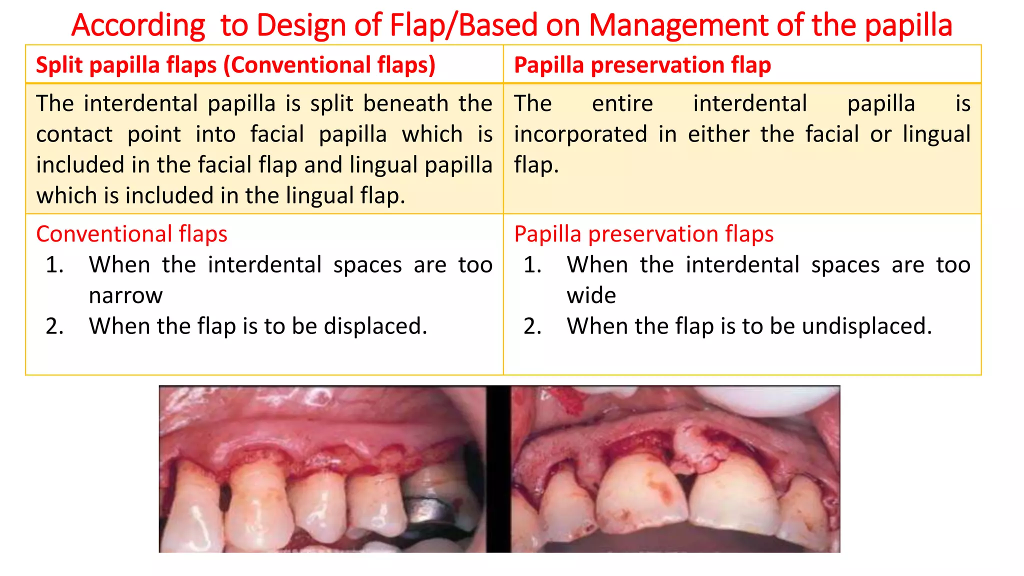 Periodontal surgery | PPTX