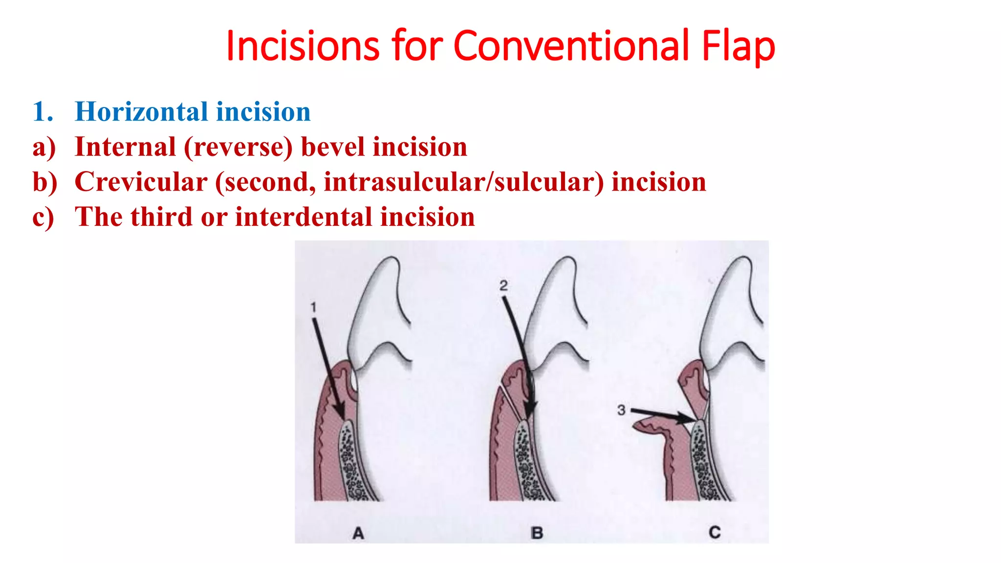 Periodontal surgery | PPTX
