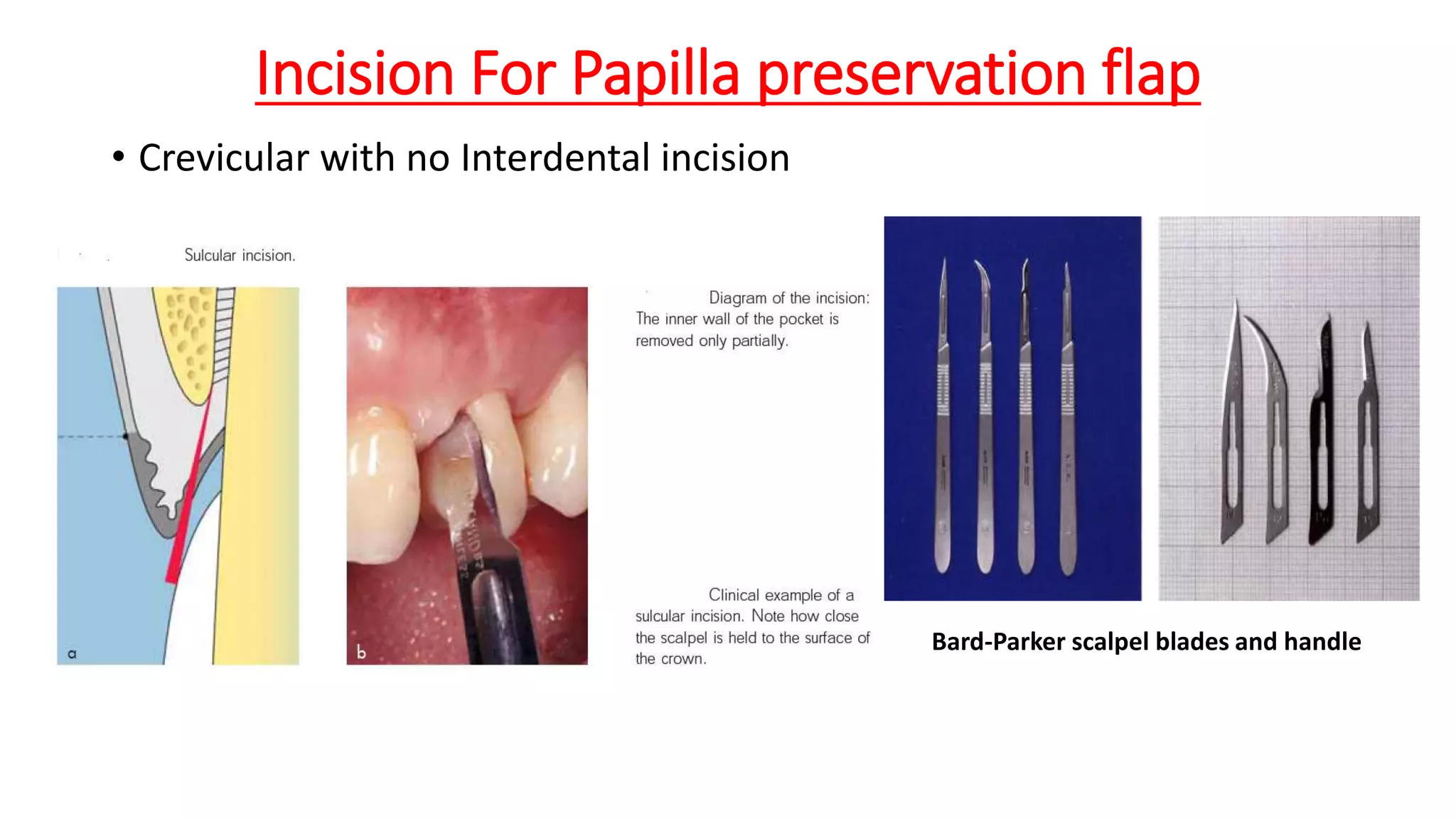 Periodontal surgery | PPTX