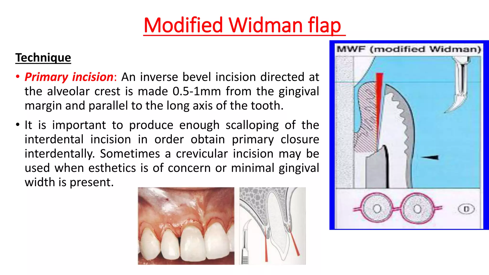 Periodontal surgery | PPTX