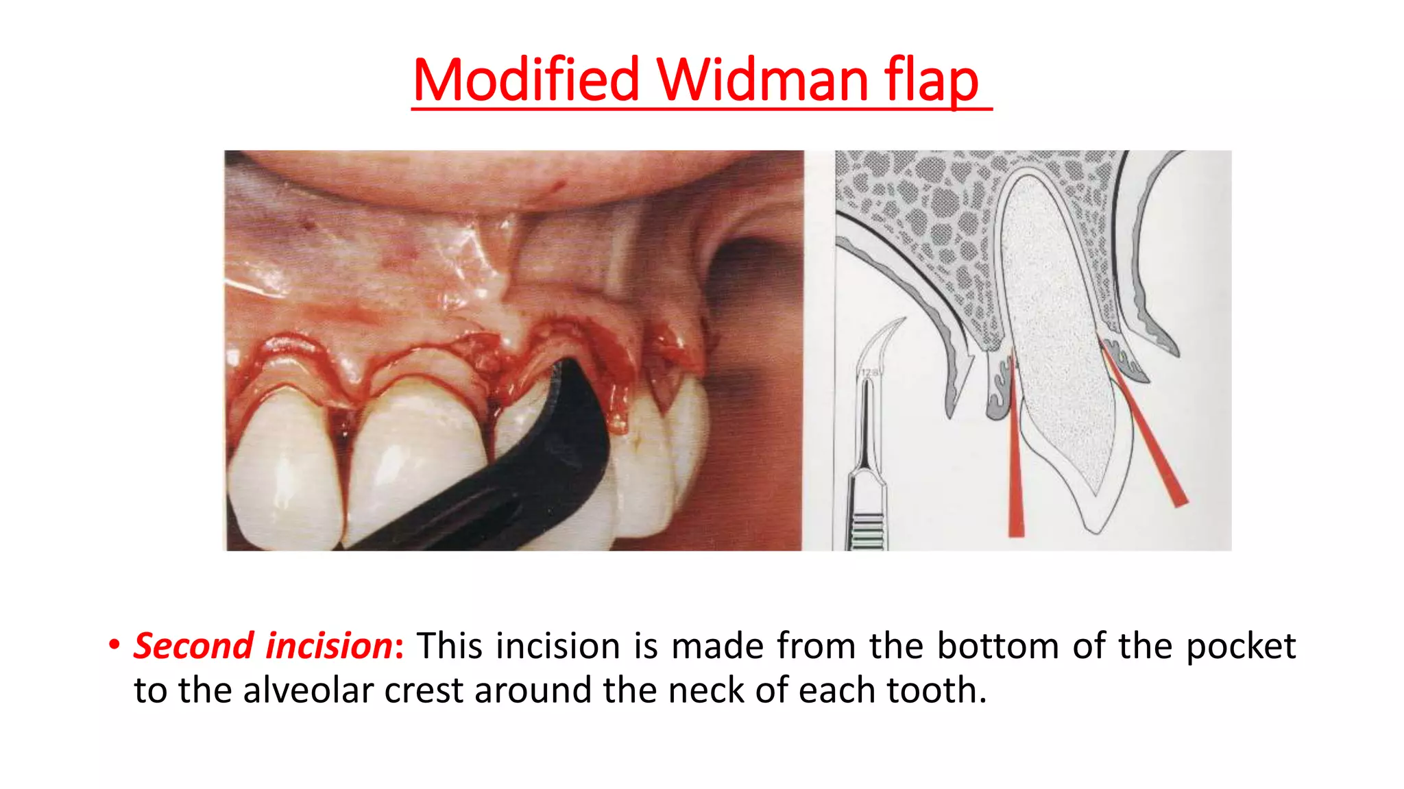 Periodontal surgery | PPTX