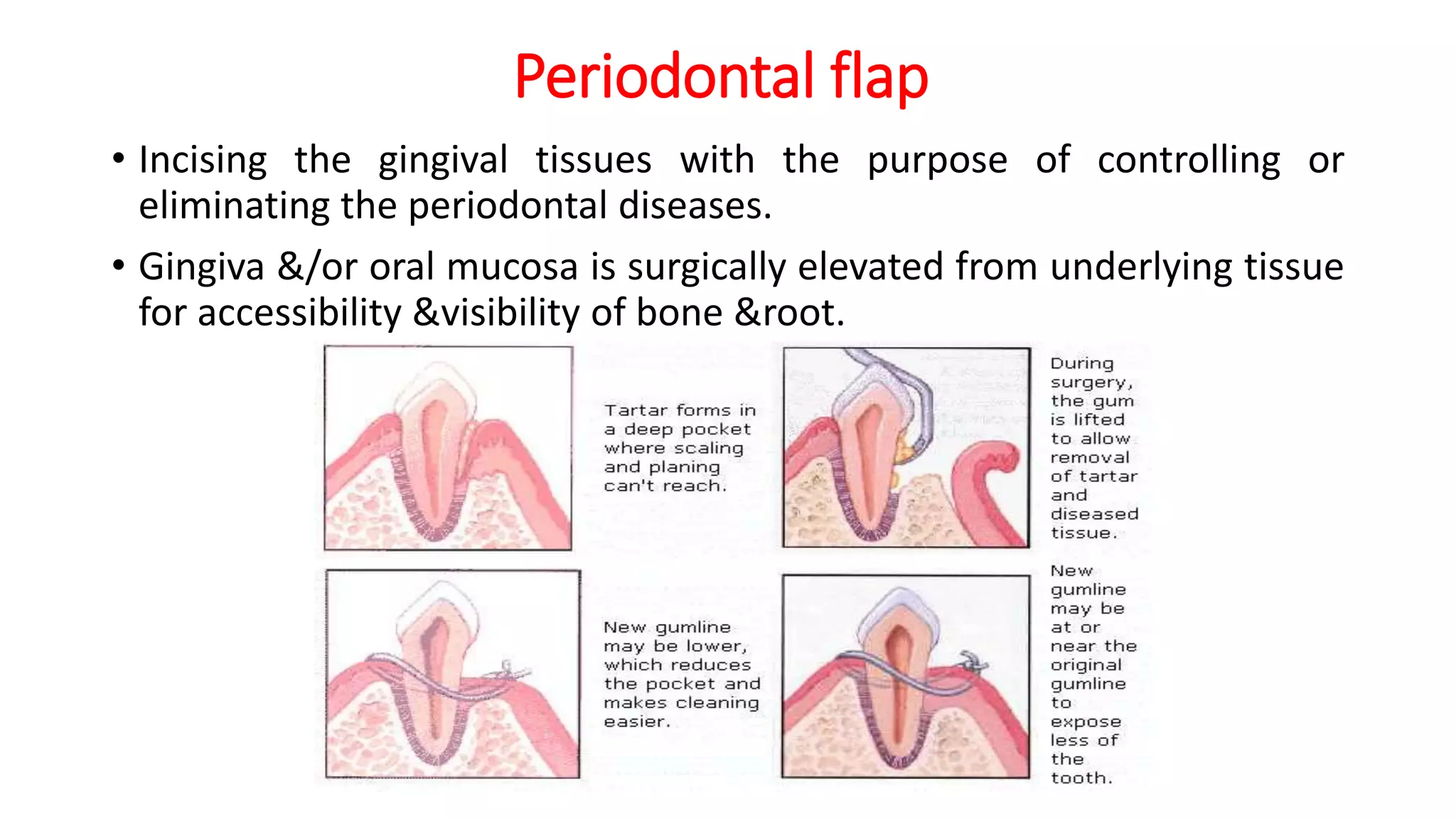 Periodontal surgery | PPTX