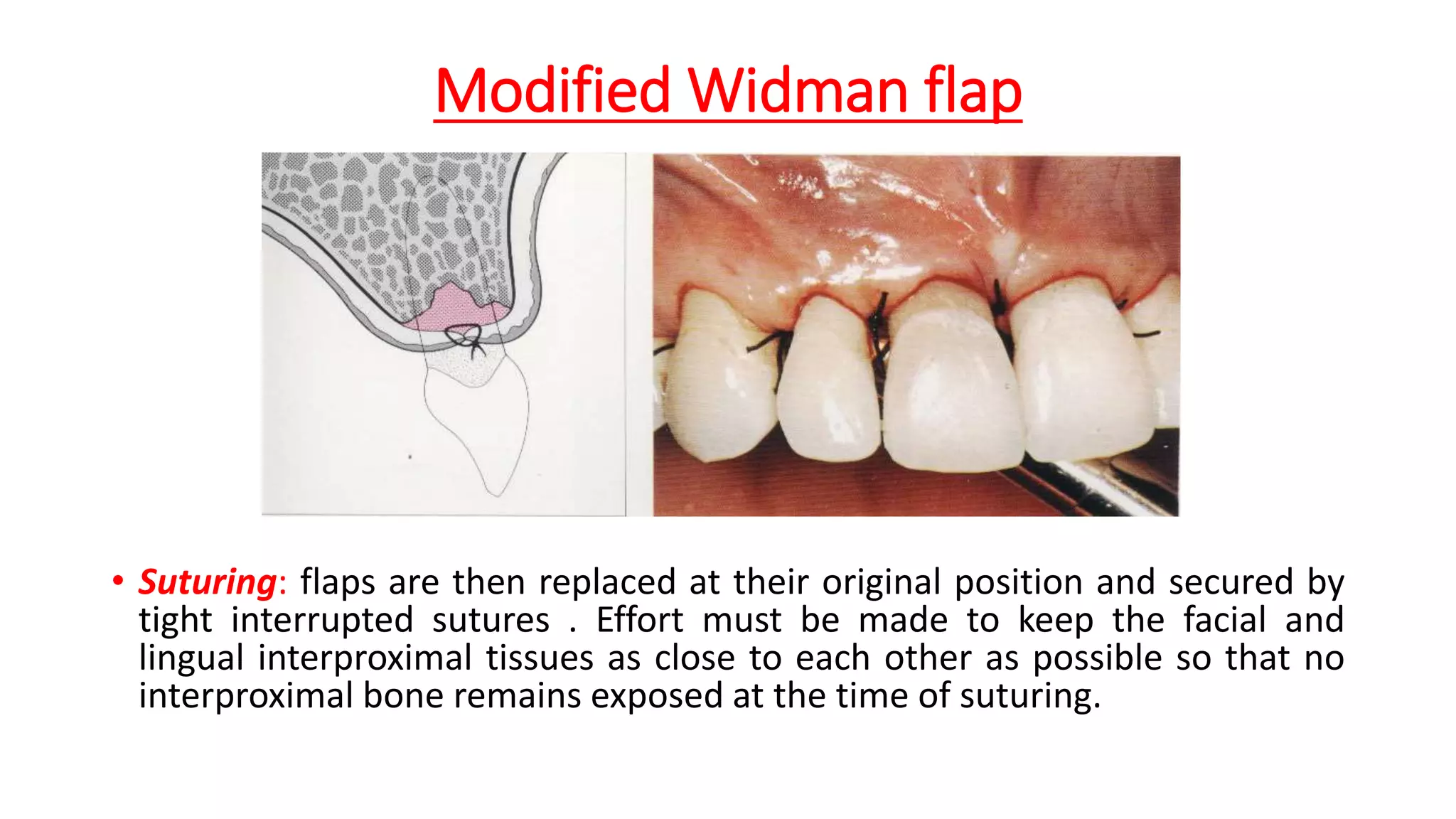 Periodontal surgery | PPTX