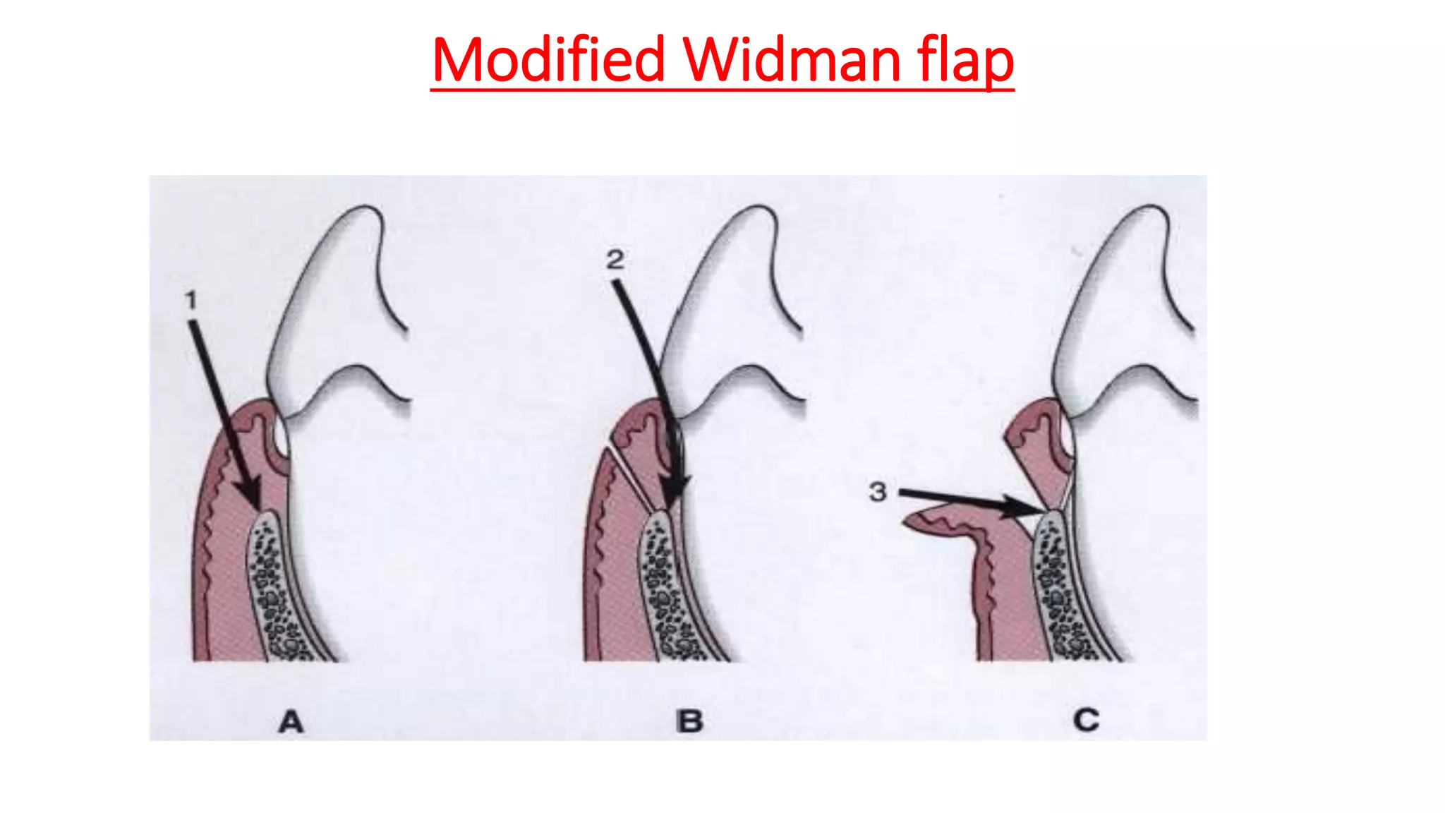Periodontal surgery | PPTX