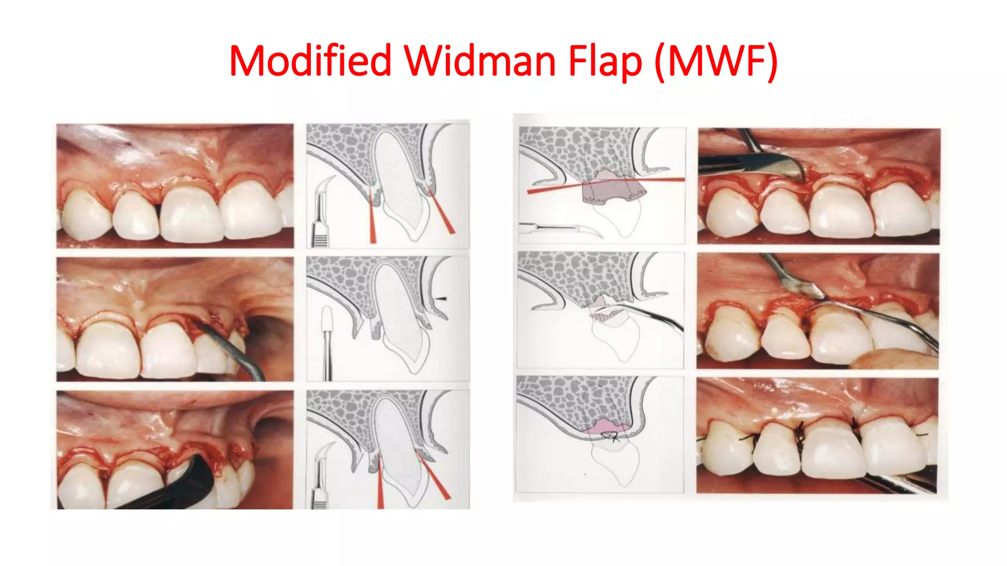 Periodontal surgery | PPTX