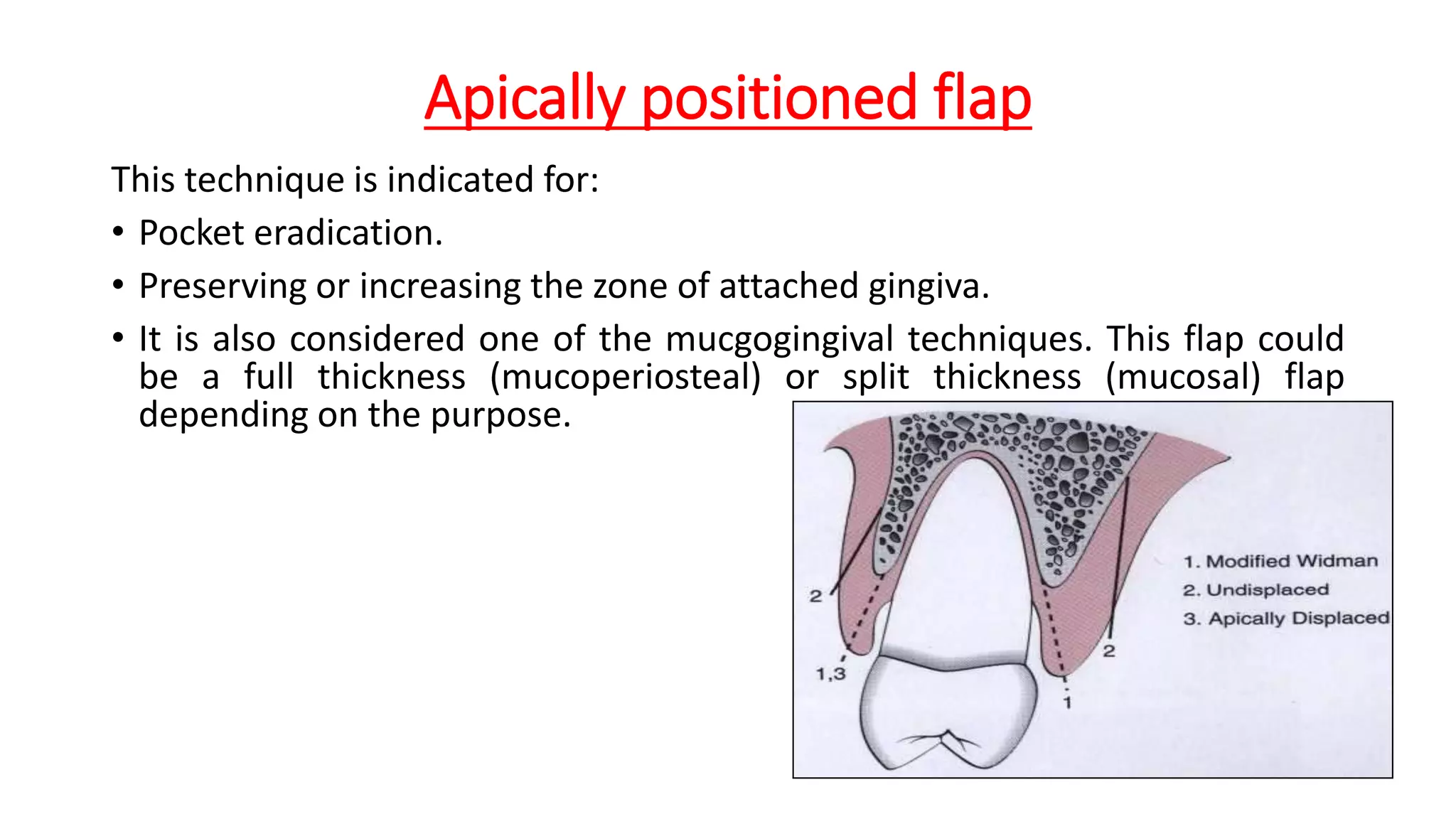 Periodontal surgery | PPTX