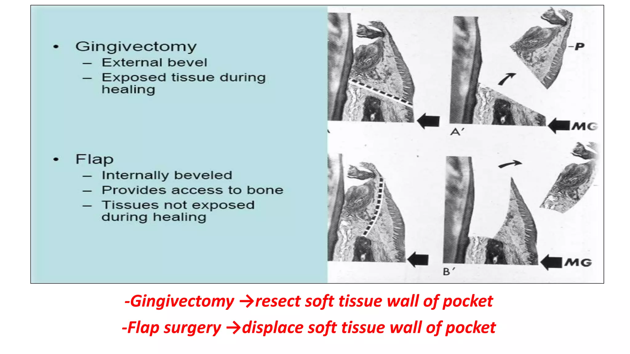 Periodontal surgery | PPTX
