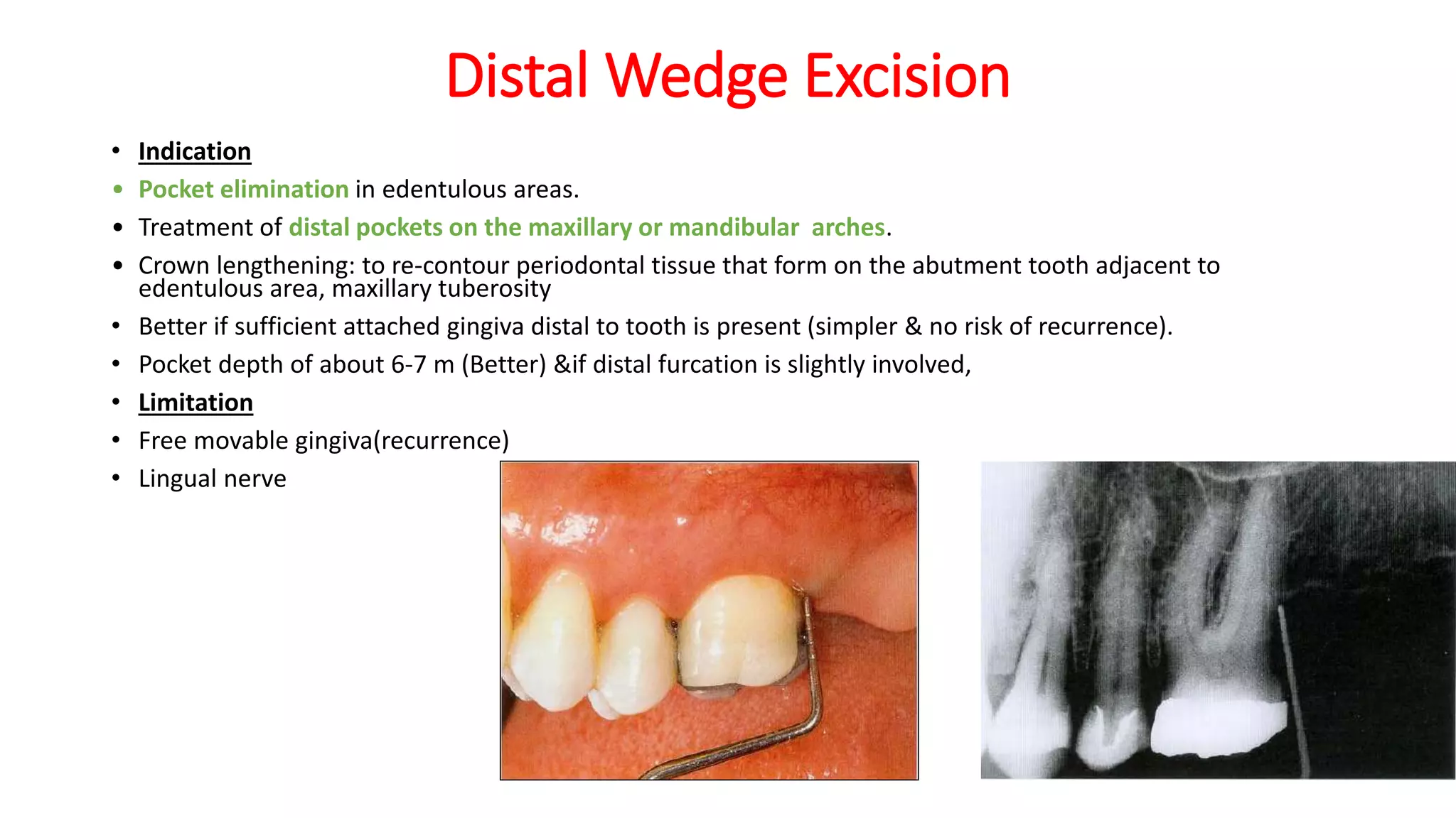 Periodontal surgery | PPTX