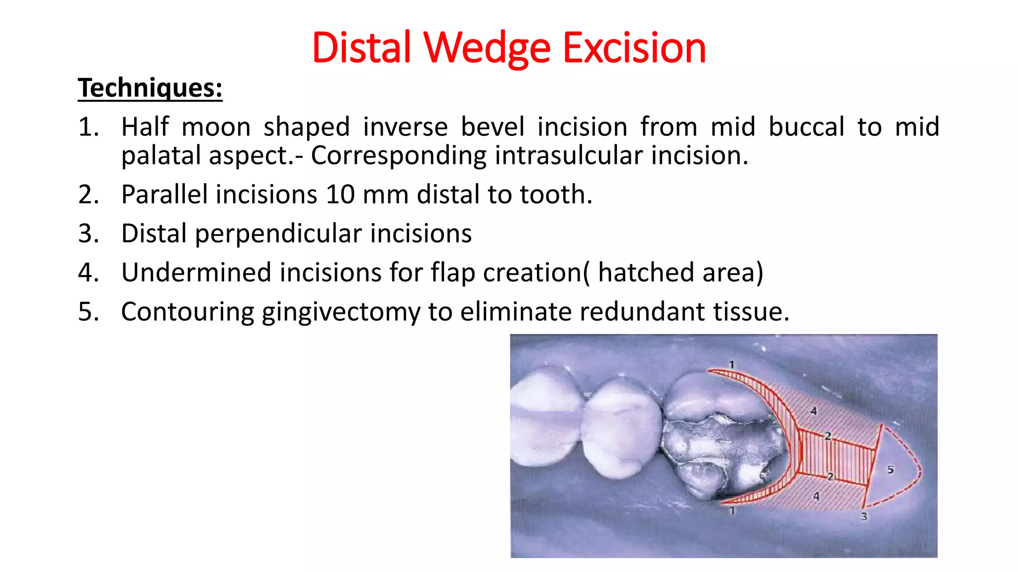 Periodontal surgery | PPTX