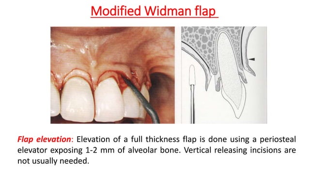 Periodontal surgery | PPTX | Dental Health | Diseases and Conditions