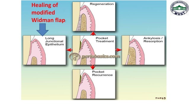 Periodontal surgery | PPTX | Dental Health | Diseases and Conditions