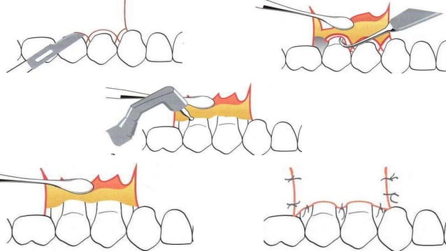 Periodontal surgery | PPTX | Dental Health | Diseases and Conditions