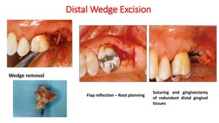 Periodontal surgery | PPTX