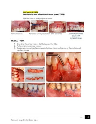 Periodontal surgery cezar pdf | PDF