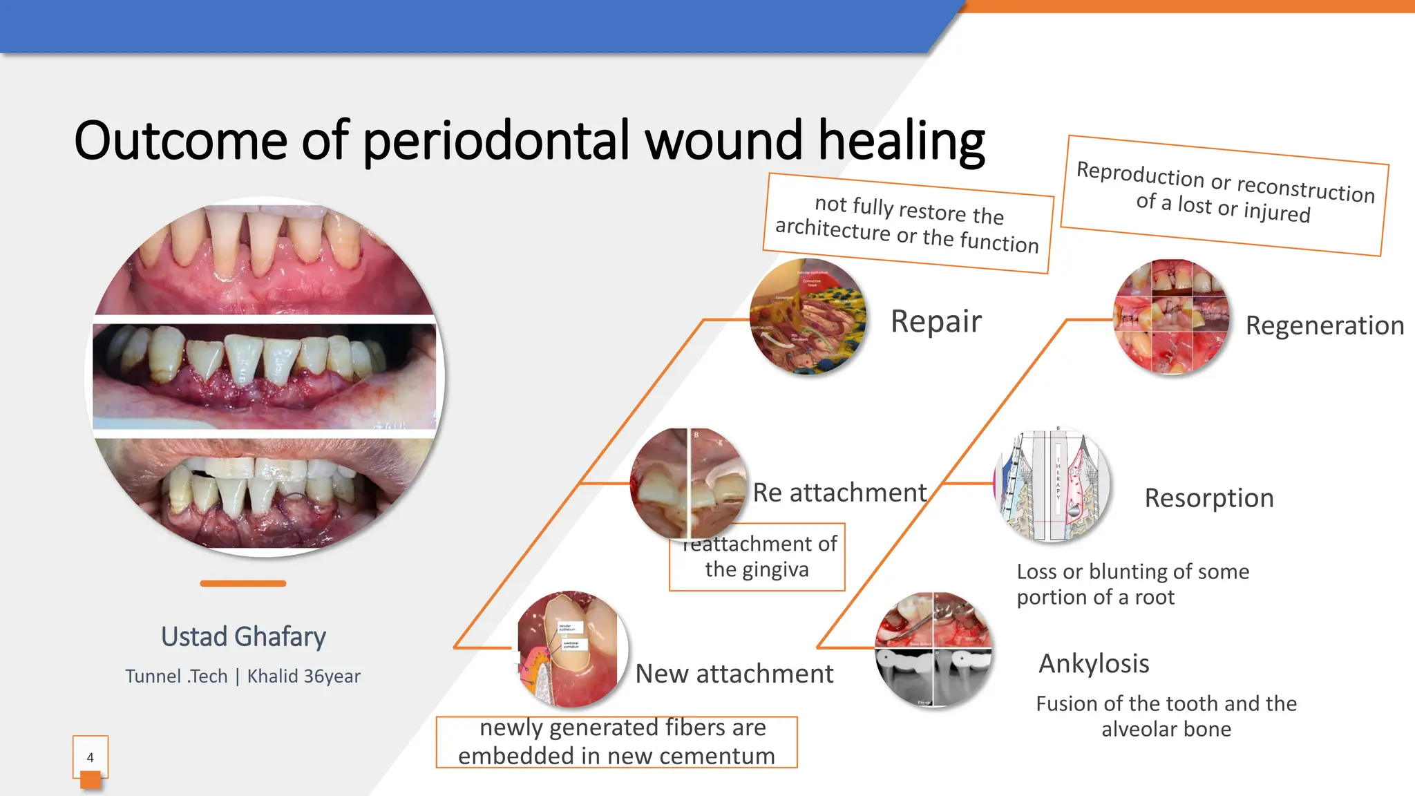 ترمیم زخم پریودنتال periodontal wound healing.pdf