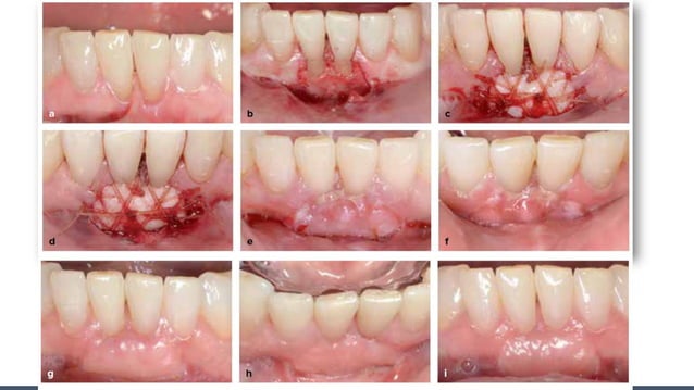ترمیم زخم پریودنتال periodontal wound healing.pdf