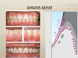 Jaringan Penyangga Gigi | PPTX