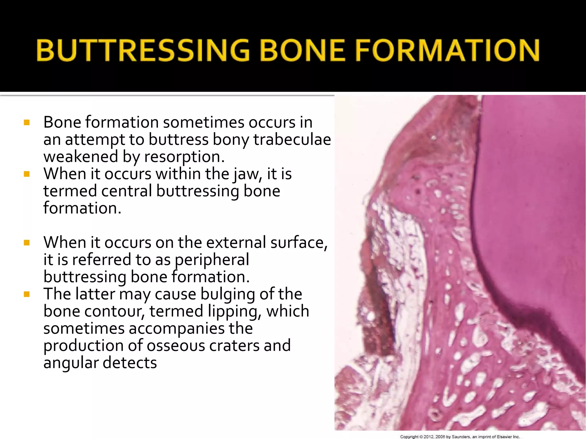 Bone destruction Periodontics *(ViRa)* | PPTX