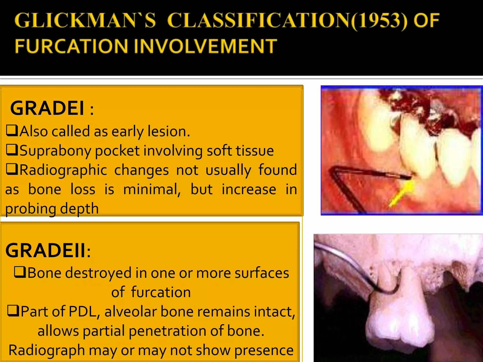 Bone destruction Periodontics *(ViRa)* | PPTX